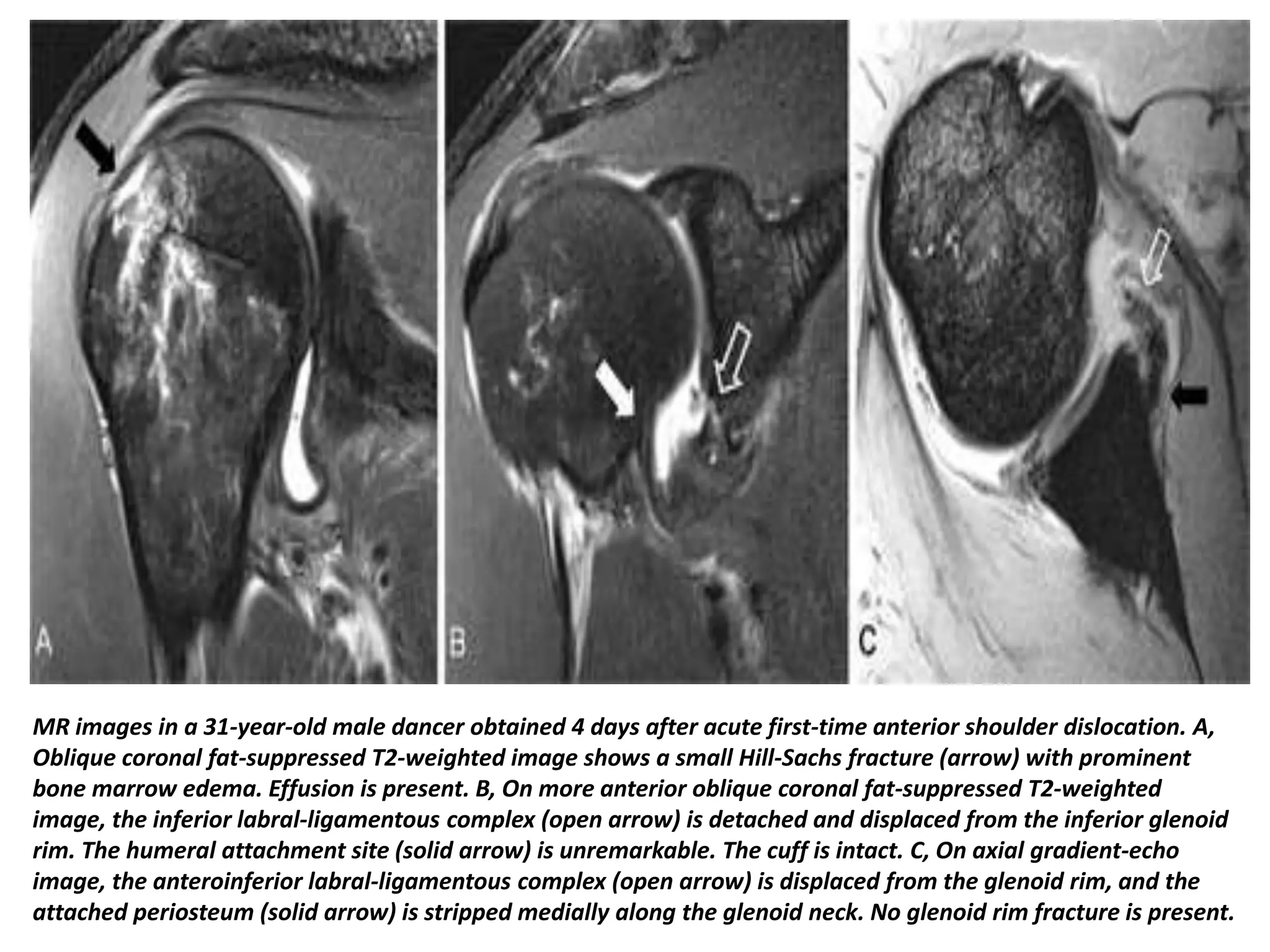 Presentation1, radiological imaging of shoulder dislocation. | PPTX