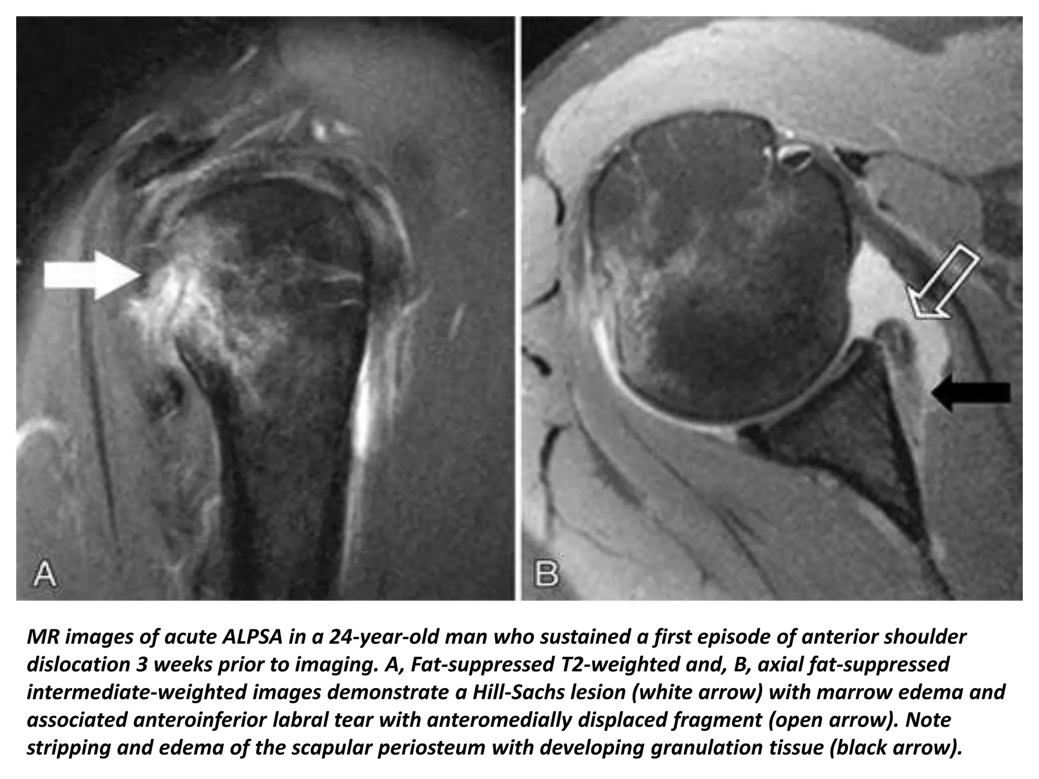 Presentation1, radiological imaging of shoulder dislocation. | PPTX