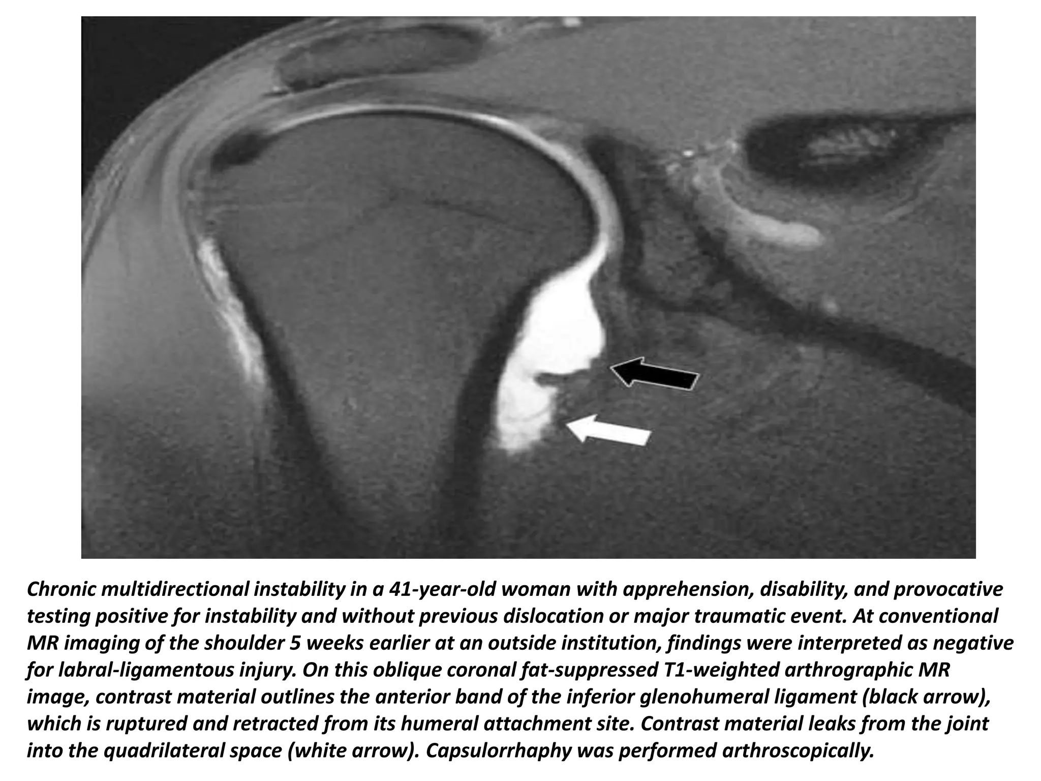 Presentation1, radiological imaging of shoulder dislocation. | PPTX