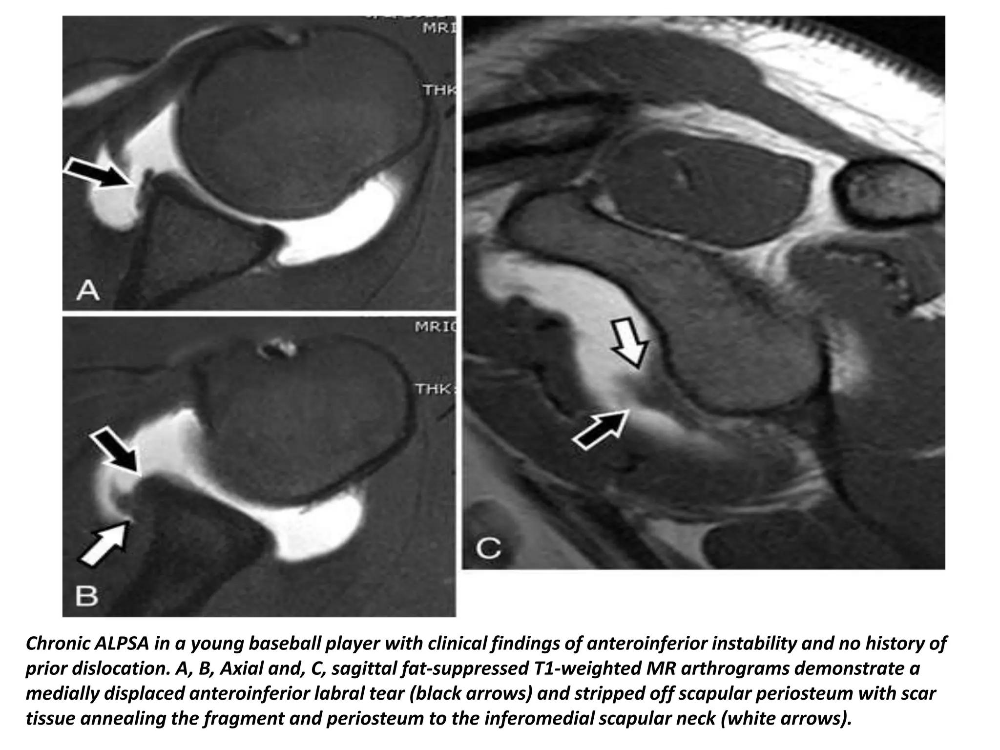 Presentation1, radiological imaging of shoulder dislocation. | PPTX
