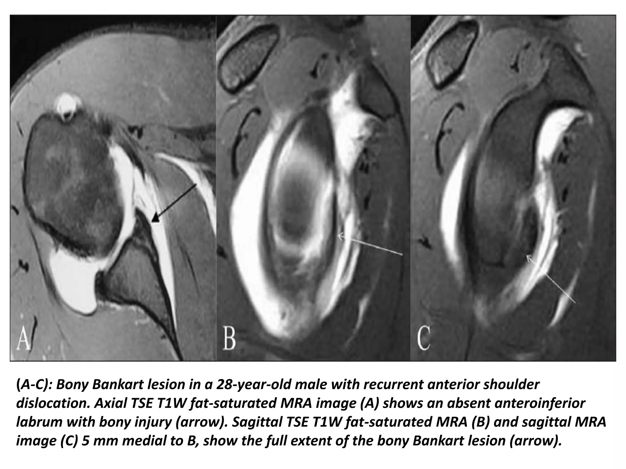 Presentation1, radiological imaging of shoulder dislocation. | PPTX