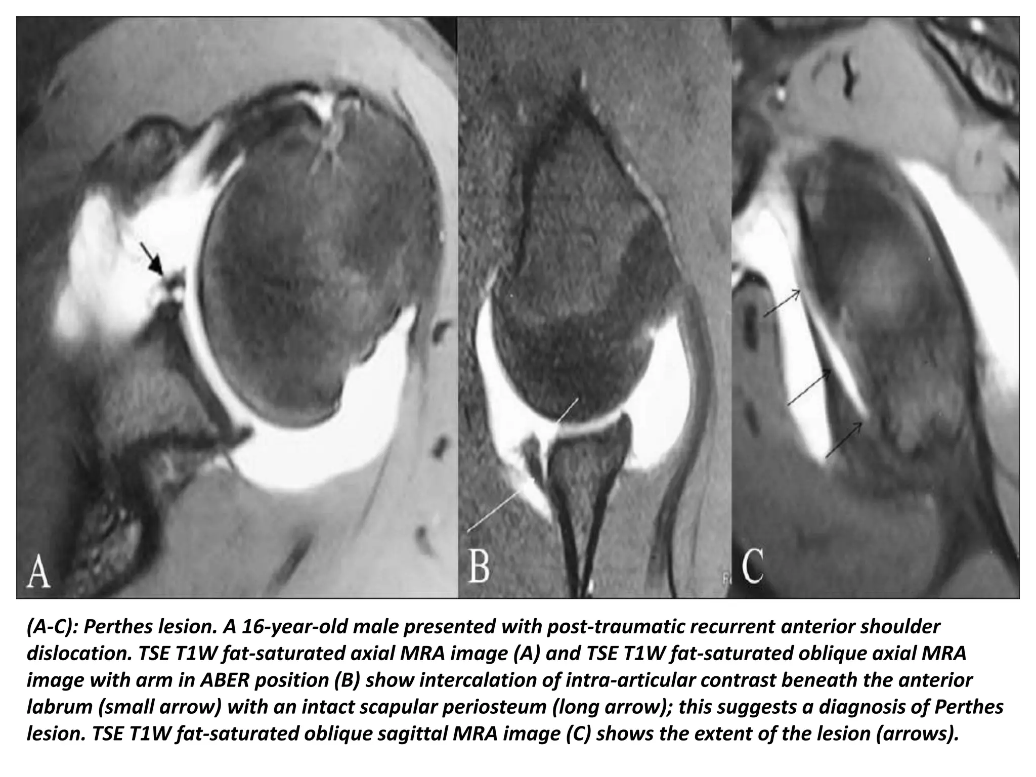 Presentation1, radiological imaging of shoulder dislocation. | PPTX