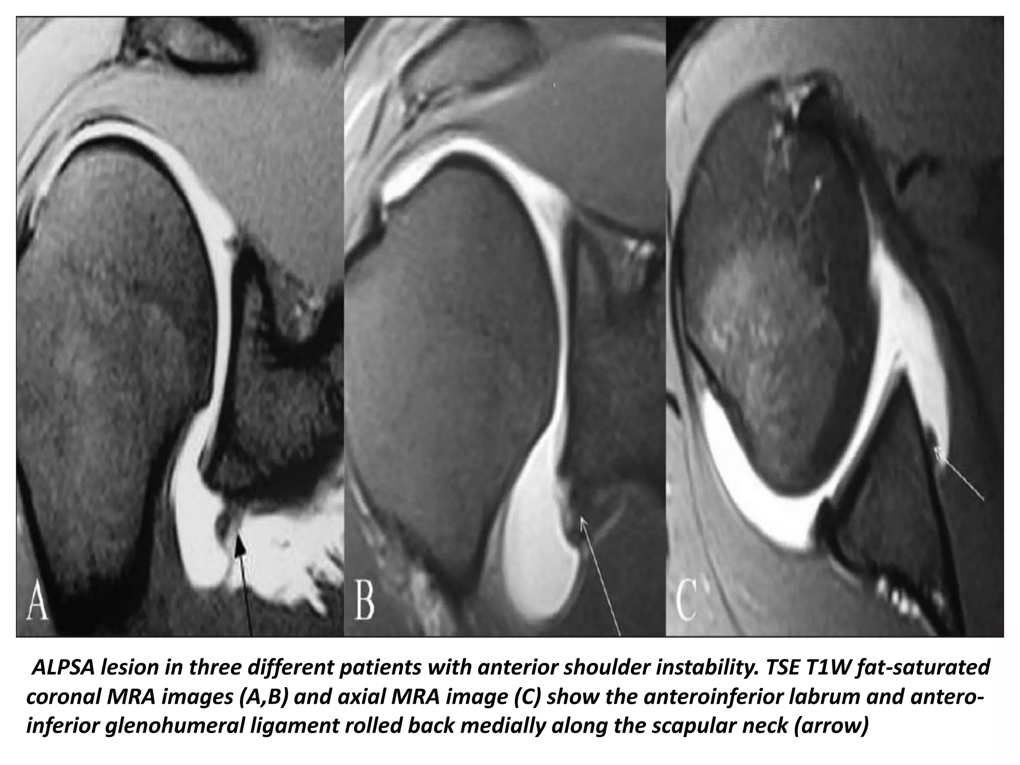 Presentation1, radiological imaging of shoulder dislocation. | PPTX