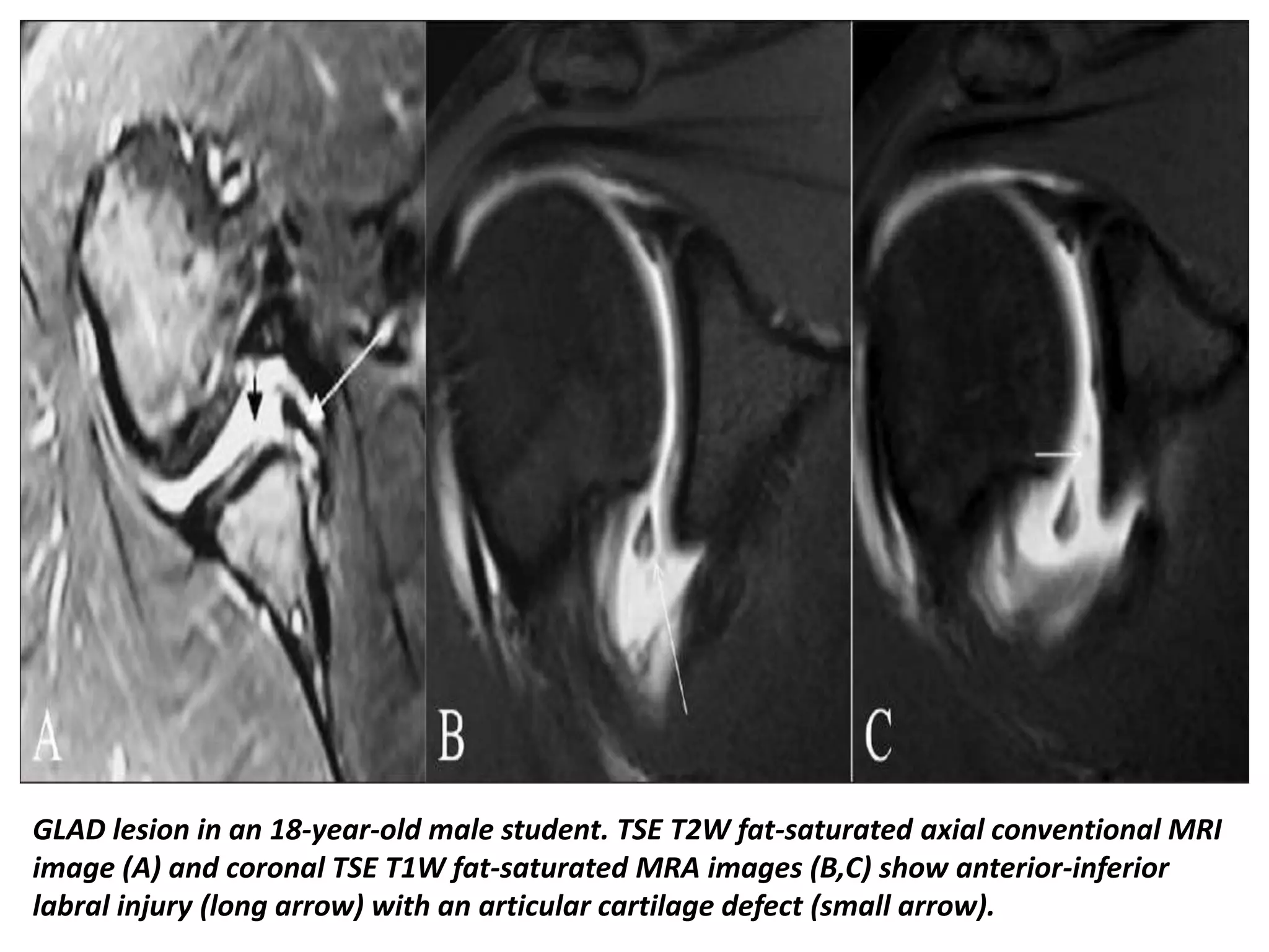 Presentation1, radiological imaging of shoulder dislocation. | PPTX