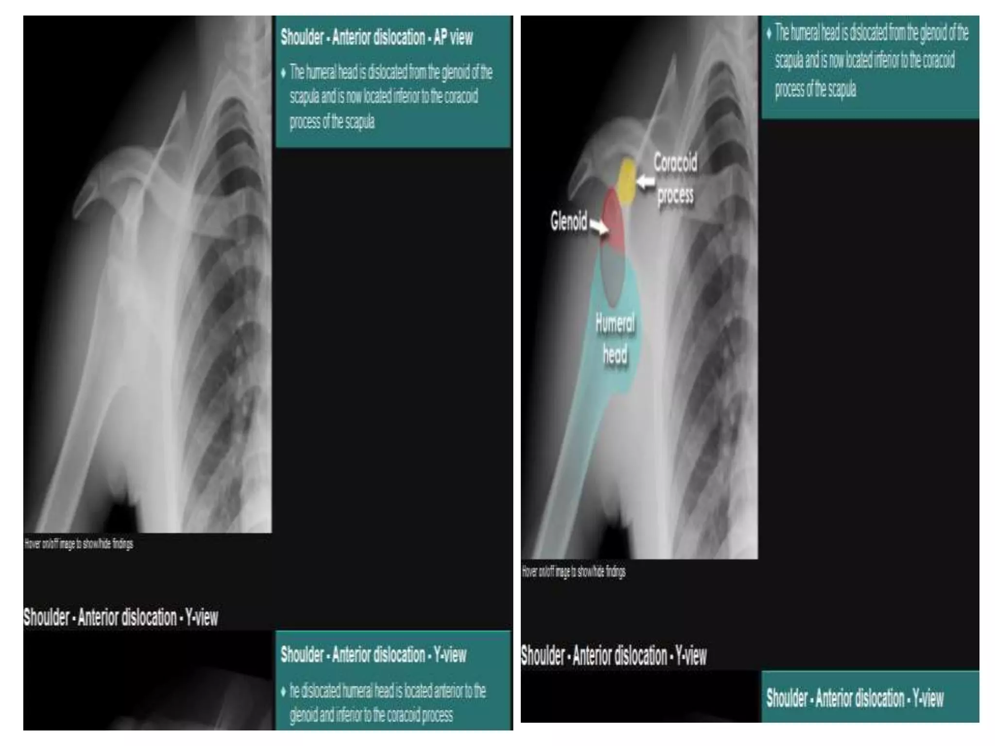 Presentation1, radiological imaging of shoulder dislocation. | PPTX