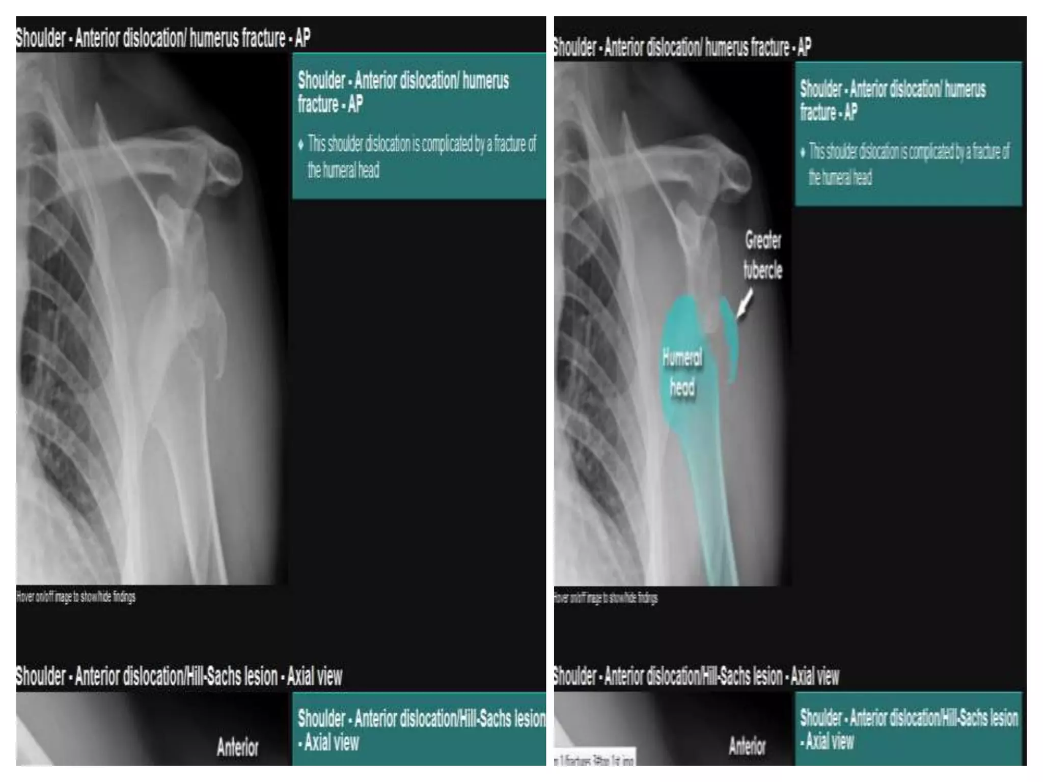 Presentation1, radiological imaging of shoulder dislocation. | PPTX