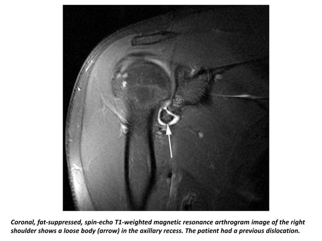 Presentation1, radiological imaging of shoulder dislocation. | PPTX ...