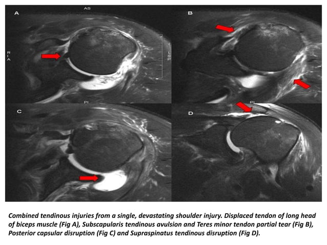 Presentation1, radiological imaging of shoulder dislocation. | PPTX ...