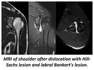 Mri Shoulder Dislocation