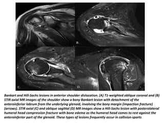 Mri Shoulder Dislocation