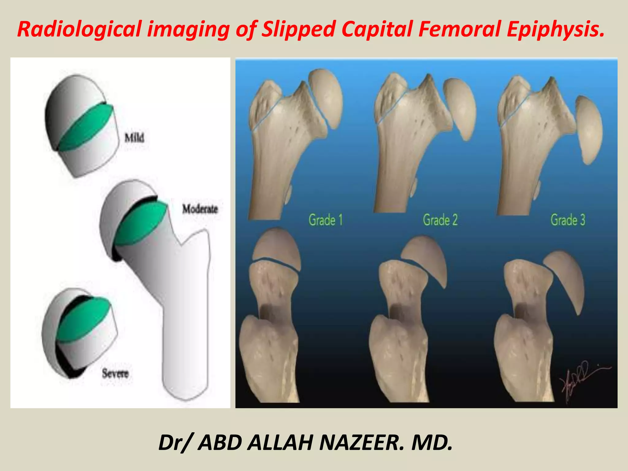Presentation1, radiological imaging of slipped femoral capital ...