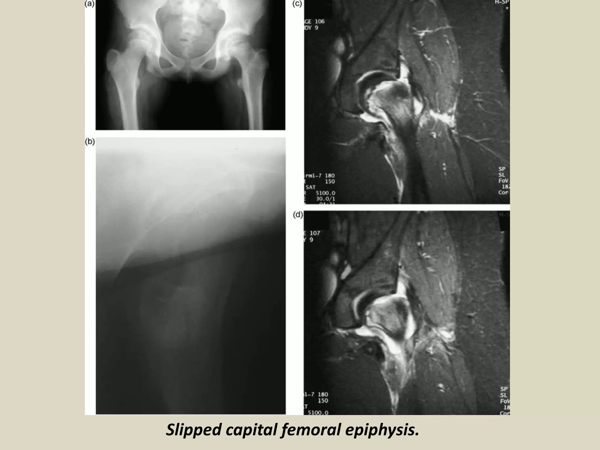 Presentation1, radiological imaging of slipped femoral capital ...