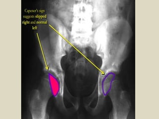 Presentation1, radiological imaging of slipped femoral capital ...