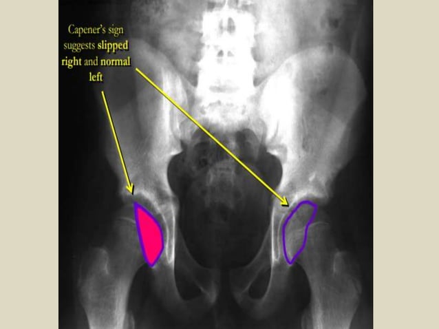 Presentation1, radiological imaging of slipped femoral capital ...