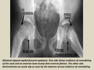 Presentation1, radiological imaging of slipped femoral capital ...