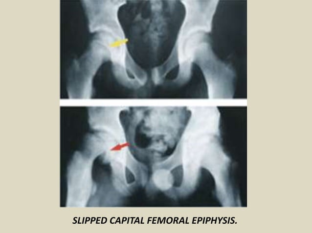 Presentation1, radiological imaging of slipped femoral capital ...