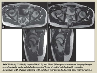 Presentation1, radiological imaging of slipped femoral capital ...