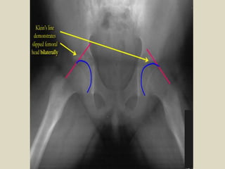 Slipped Capital Femoral Epiphysis Radiology