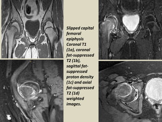 Slipped Capital Femoral Epiphysis Radiology