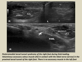 Presentation1 radiological imaging of tarsal tunnel syndrome. | PPTX