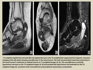 Presentation1 radiological imaging of tarsal tunnel syndrome. | PPTX