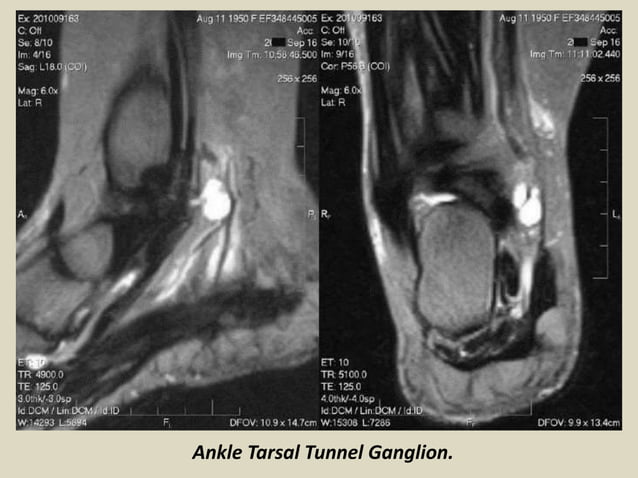 Presentation1 radiological imaging of tarsal tunnel syndrome.