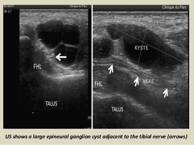 Presentation1 radiological imaging of tarsal tunnel syndrome.