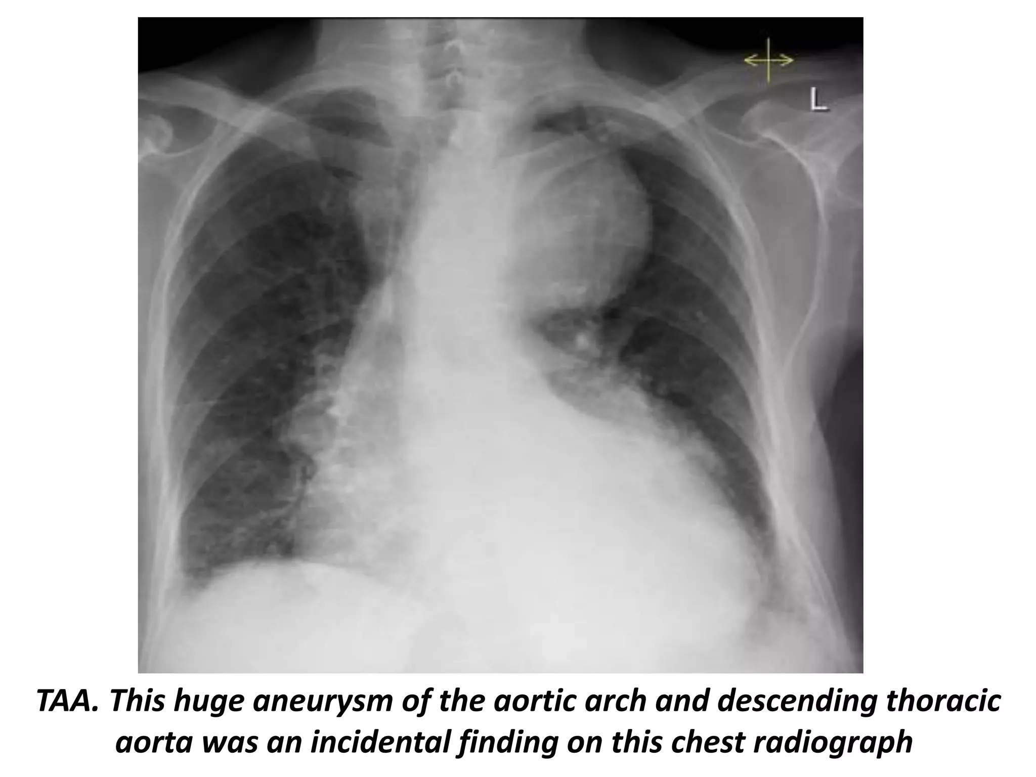 Presentation1, radiological imaging of thoracic aortic aneurysm. | PPTX
