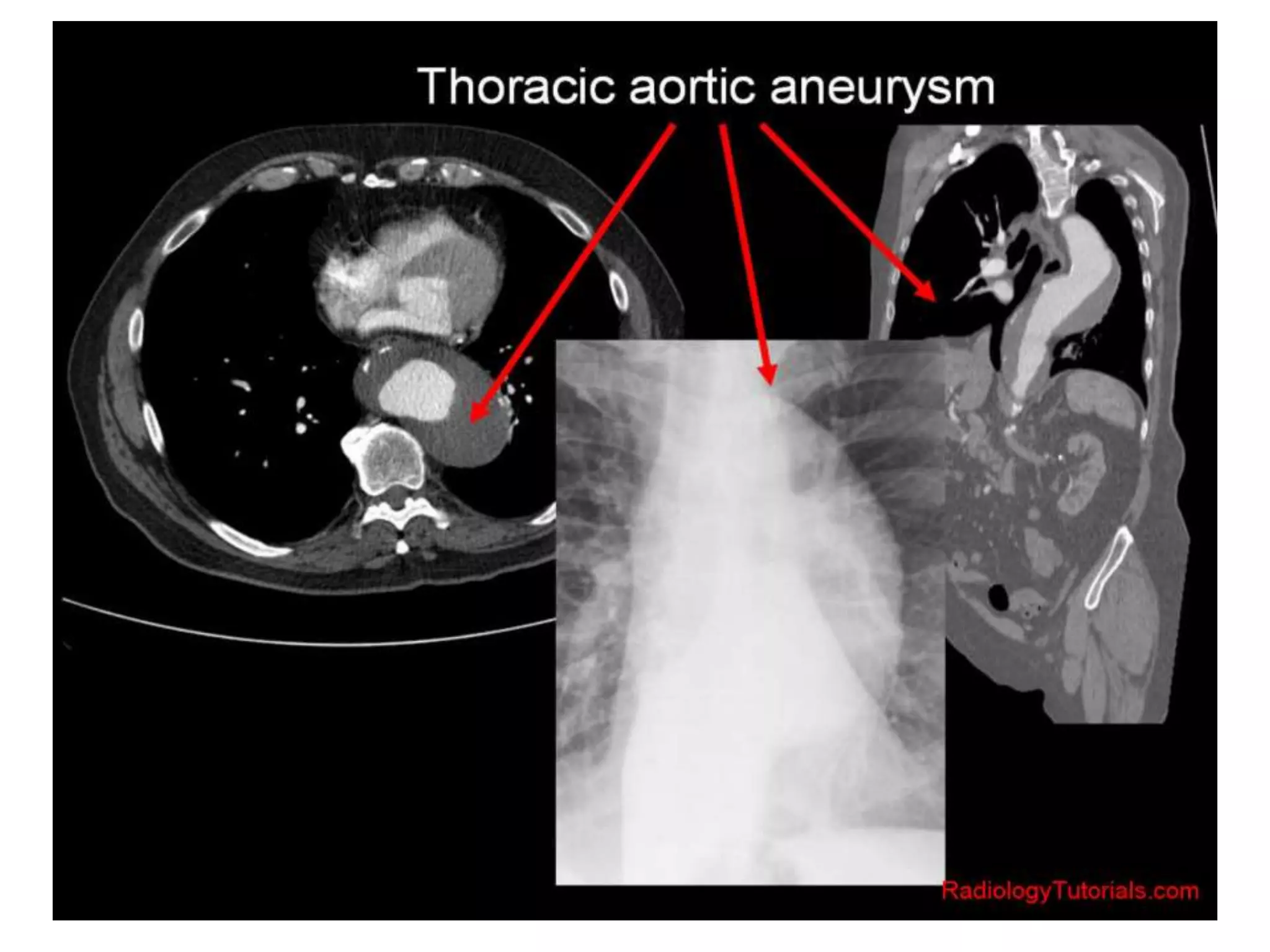 Presentation1, radiological imaging of thoracic aortic aneurysm. | PPTX