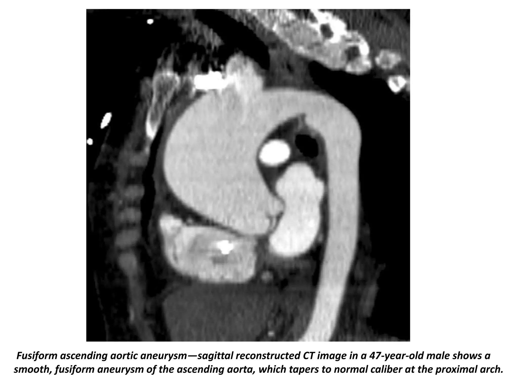 Presentation1, radiological imaging of thoracic aortic aneurysm. | PPTX