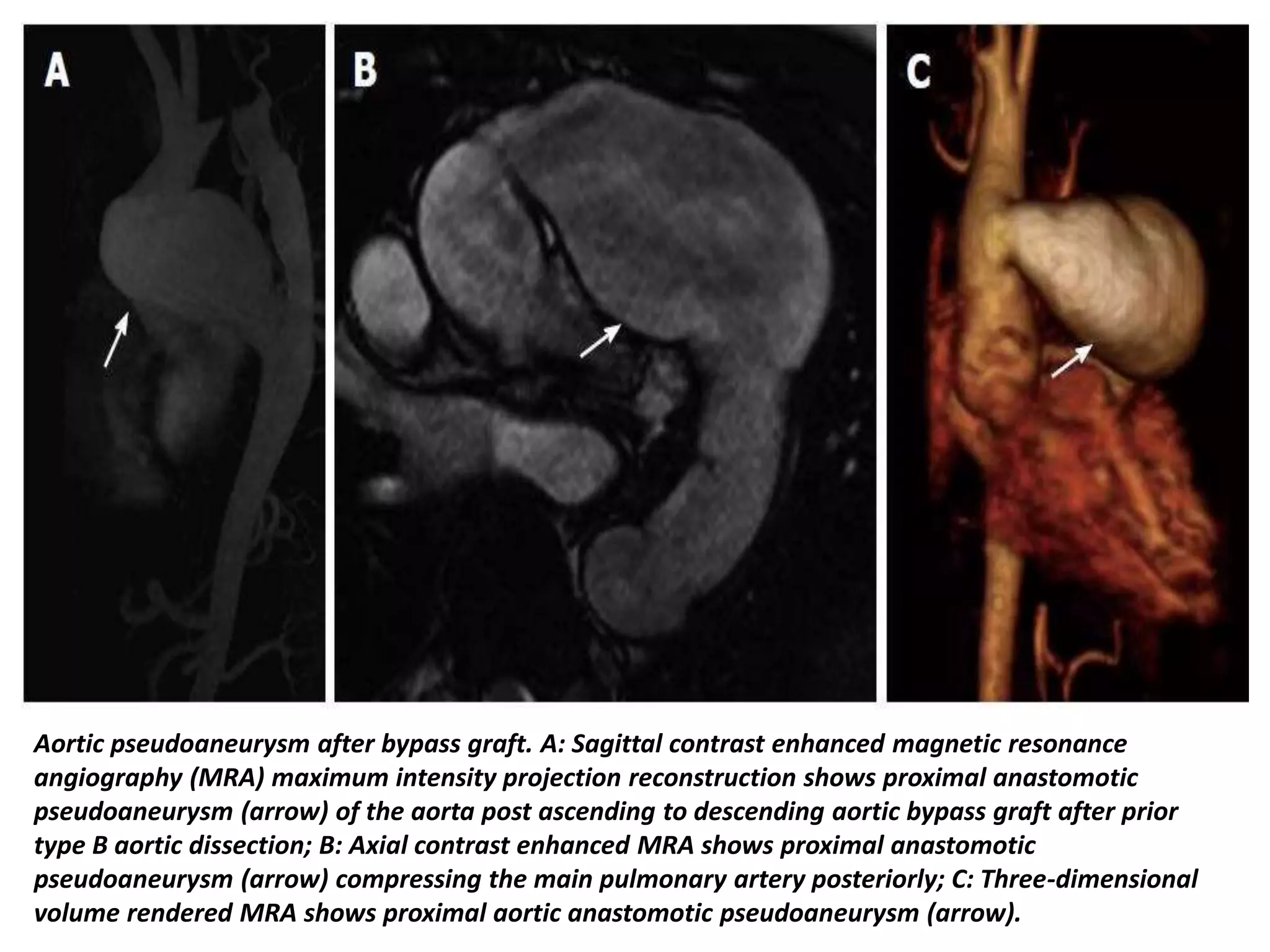 Presentation1, radiological imaging of thoracic aortic aneurysm. | PPTX
