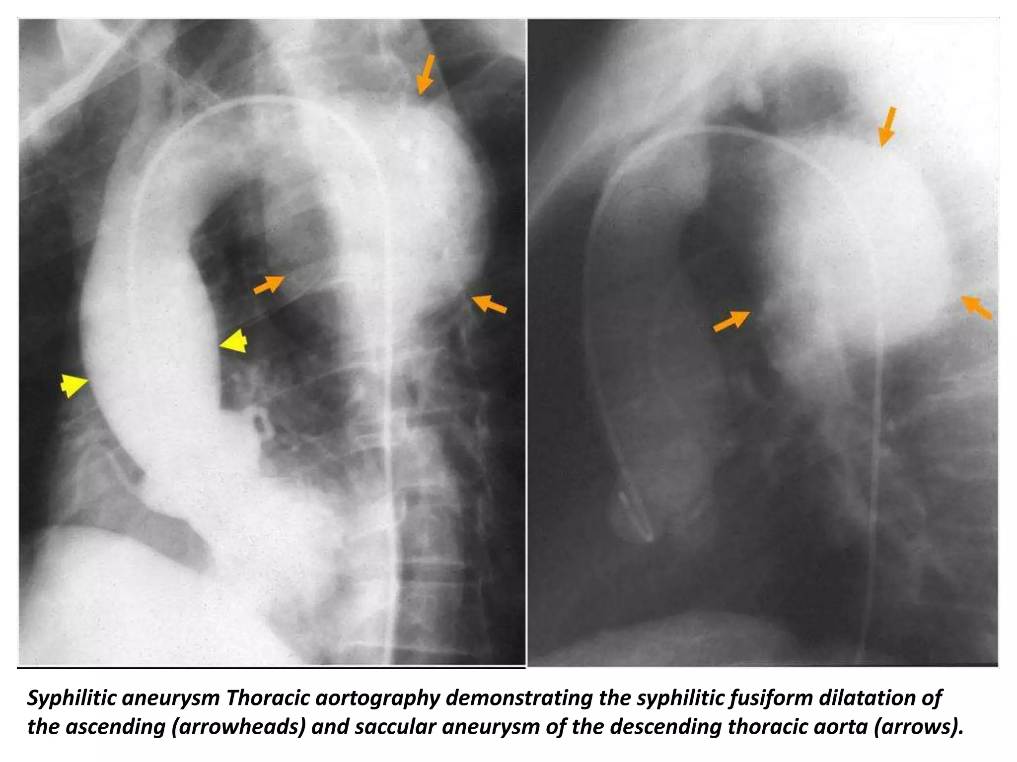 Presentation1, radiological imaging of thoracic aortic aneurysm. | PPTX