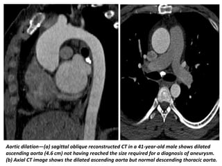 Presentation1, radiological imaging of thoracic aortic aneurysm. | PPTX