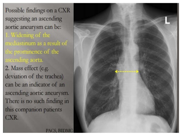 Presentation1, radiological imaging of thoracic aortic aneurysm.