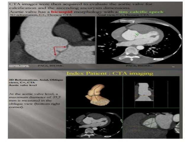 Presentation1, radiological imaging of thoracic aortic aneurysm.