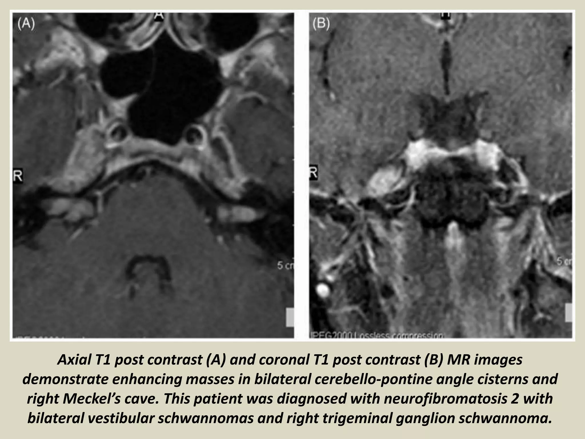 Presentation1, radiological imaging of trigeminal schwanoma. | PPTX