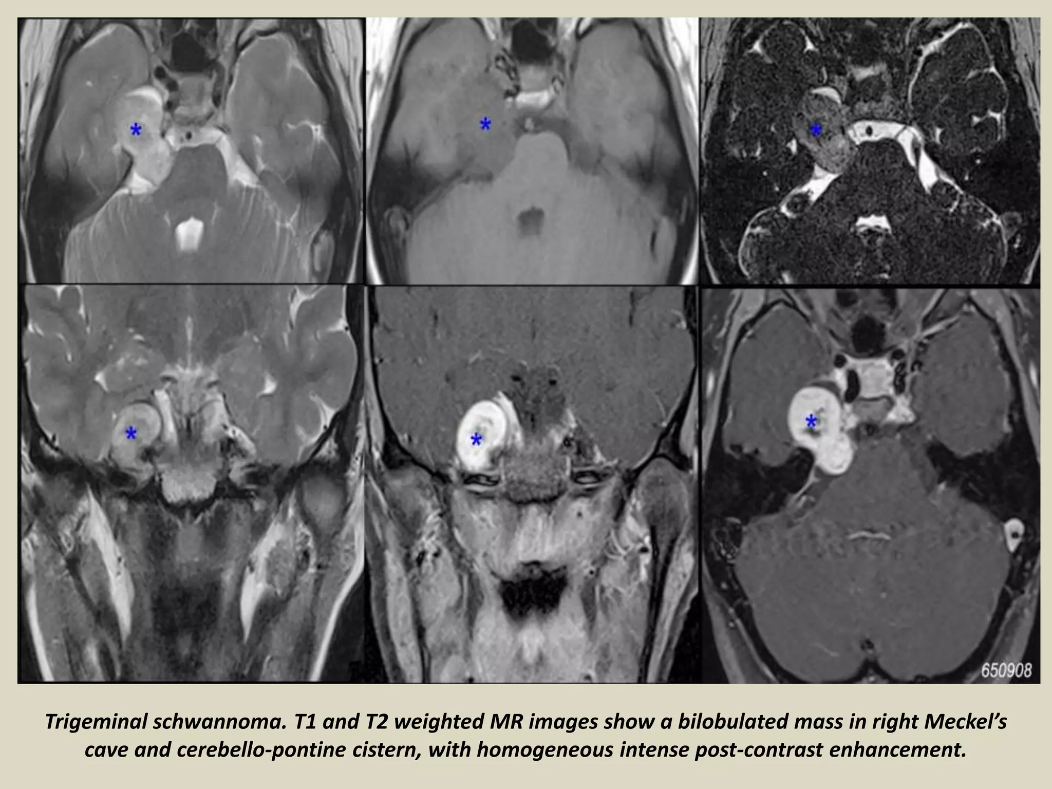 Presentation1, radiological imaging of trigeminal schwanoma. | PPTX