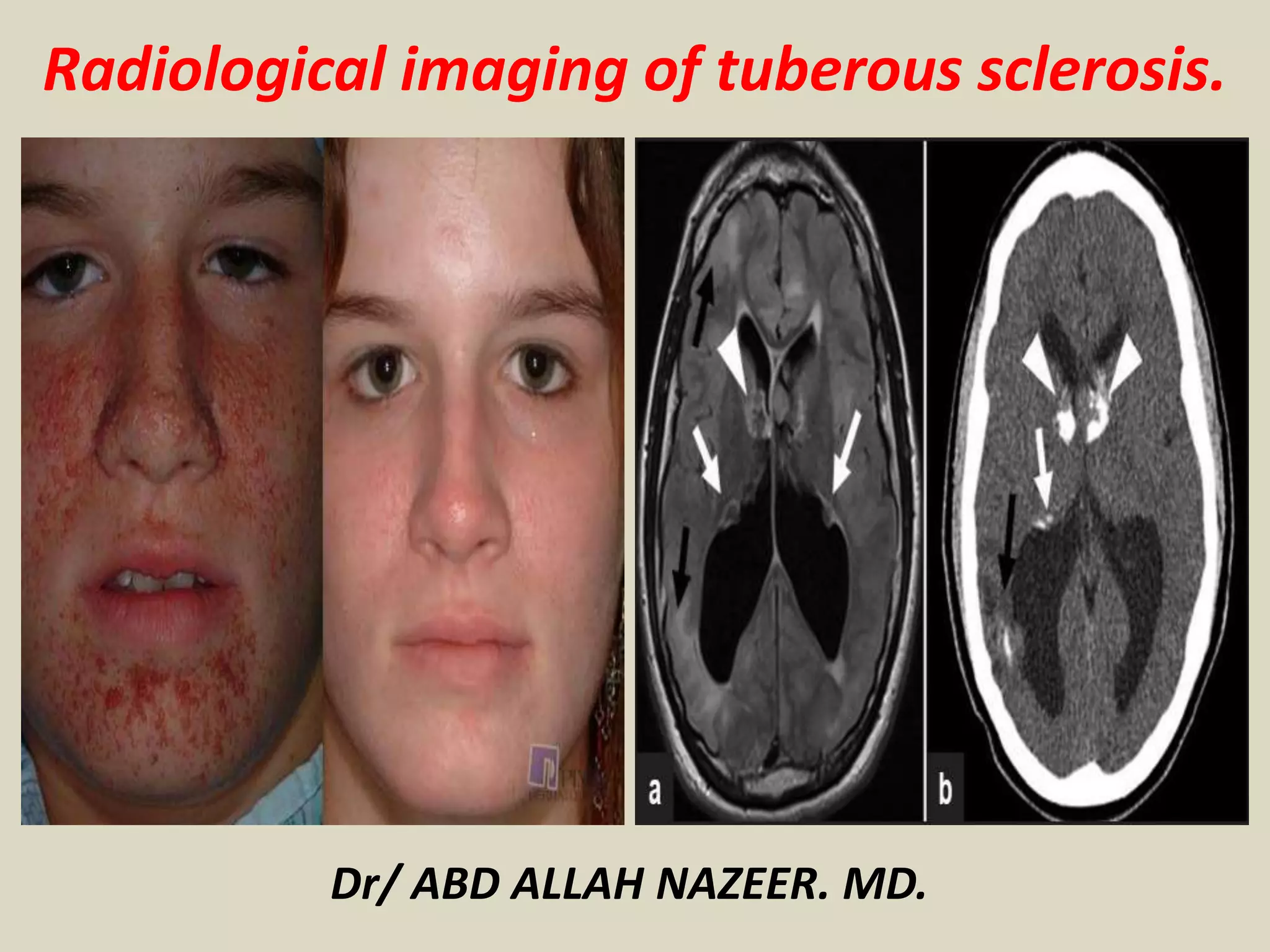 Presentation1, radiological imaging of tuberous sclerosis. | PPTX