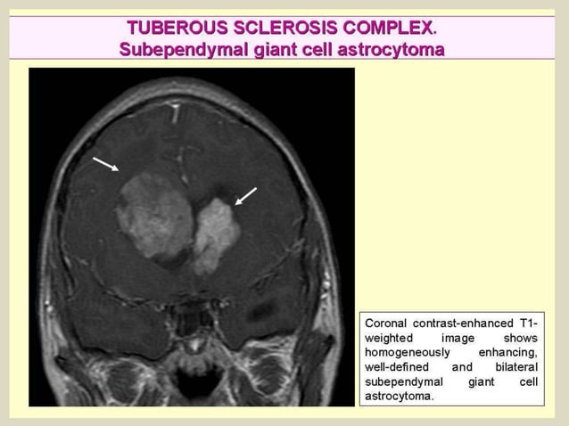 Presentation1, radiological imaging of tuberous sclerosis. | PPTX
