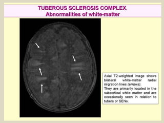 Presentation1, radiological imaging of tuberous sclerosis.
