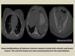 Bone Lesions Tuberous Sclerosis
