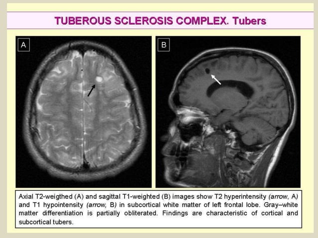 Presentation1, radiological imaging of tuberous sclerosis.