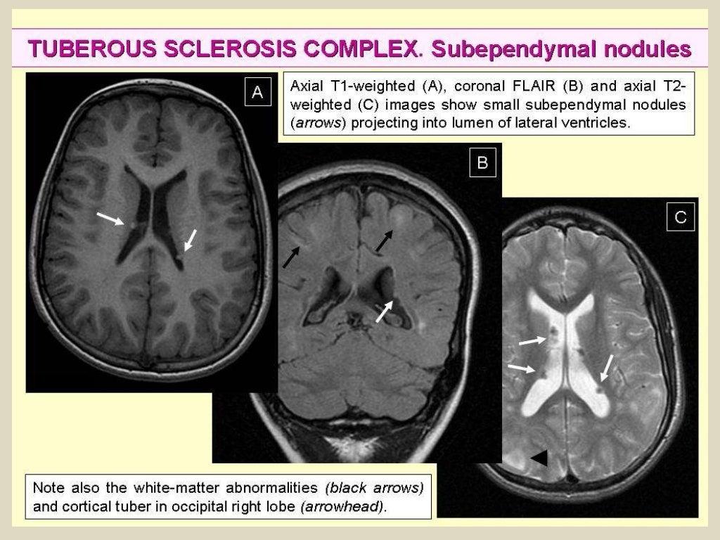 Presentation1, radiological imaging of tuberous sclerosis.