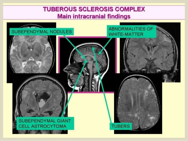 Presentation1, radiological imaging of tuberous sclerosis.