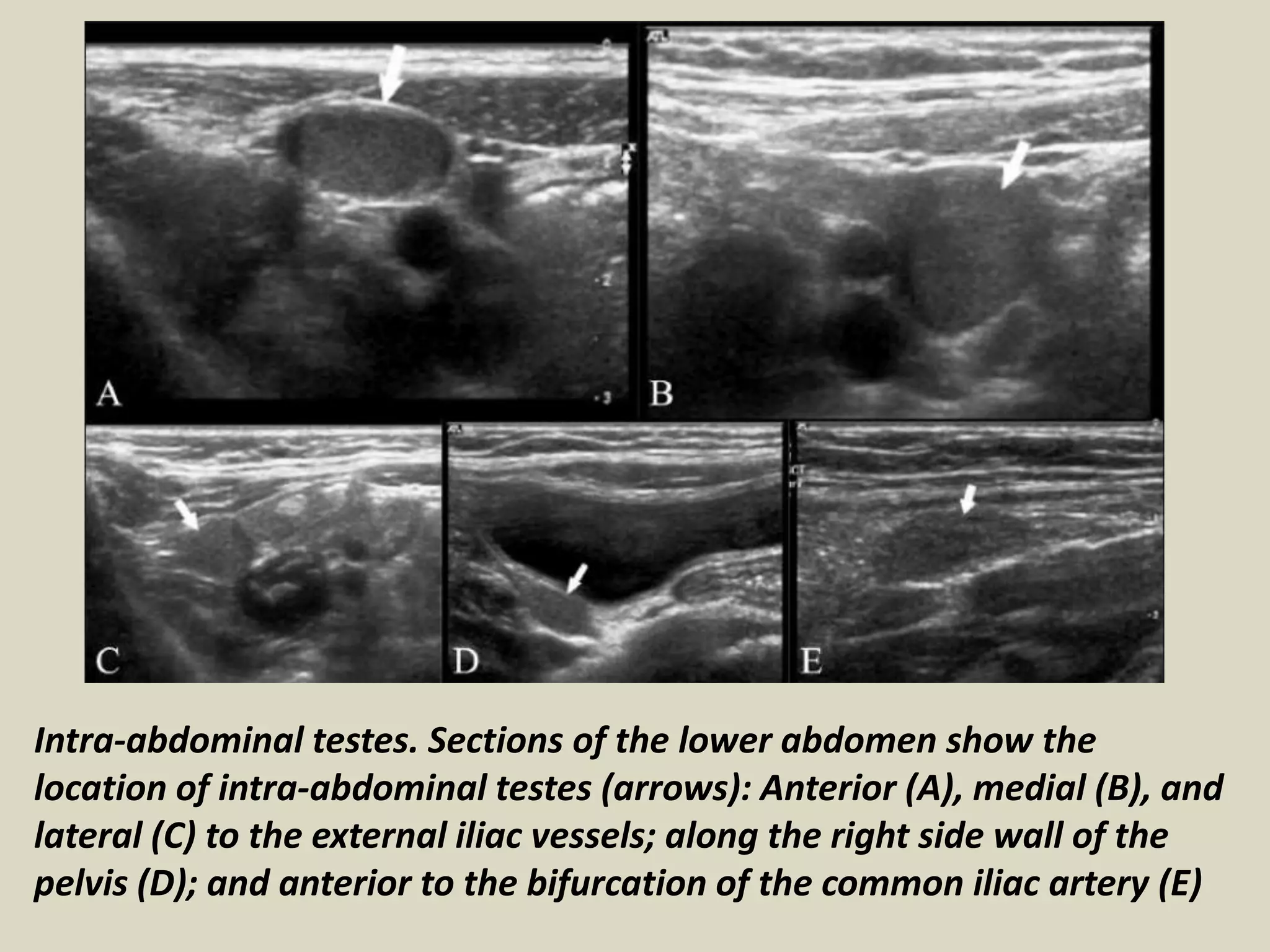 Presentation1, radiological imaging of undescended testis. | PPTX