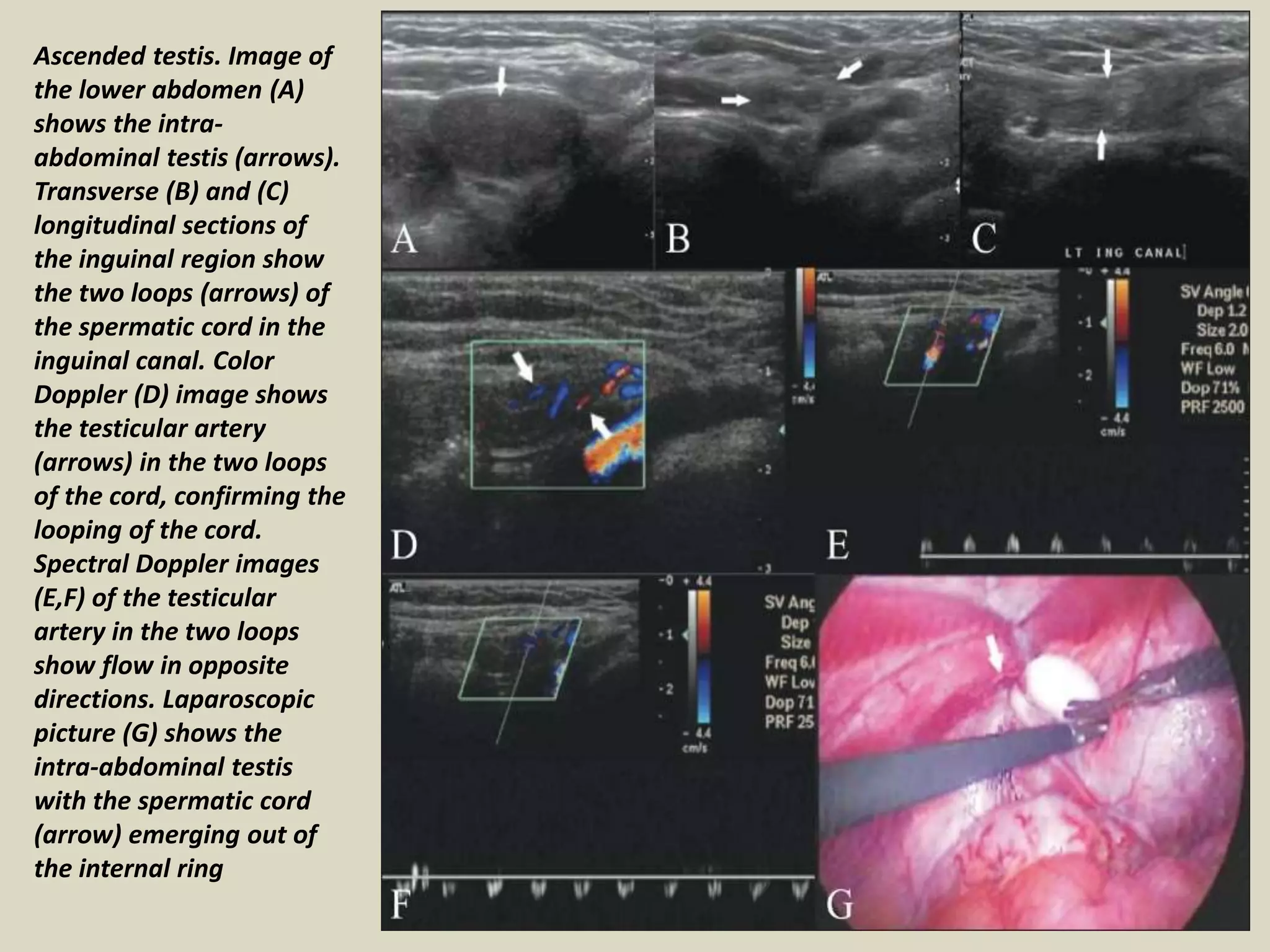 Presentation1, radiological imaging of undescended testis. | PPTX