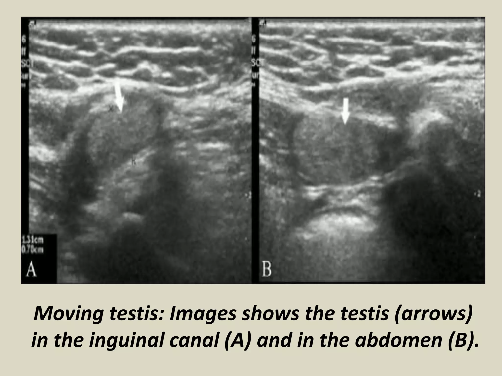 Presentation1, radiological imaging of undescended testis. | PPTX