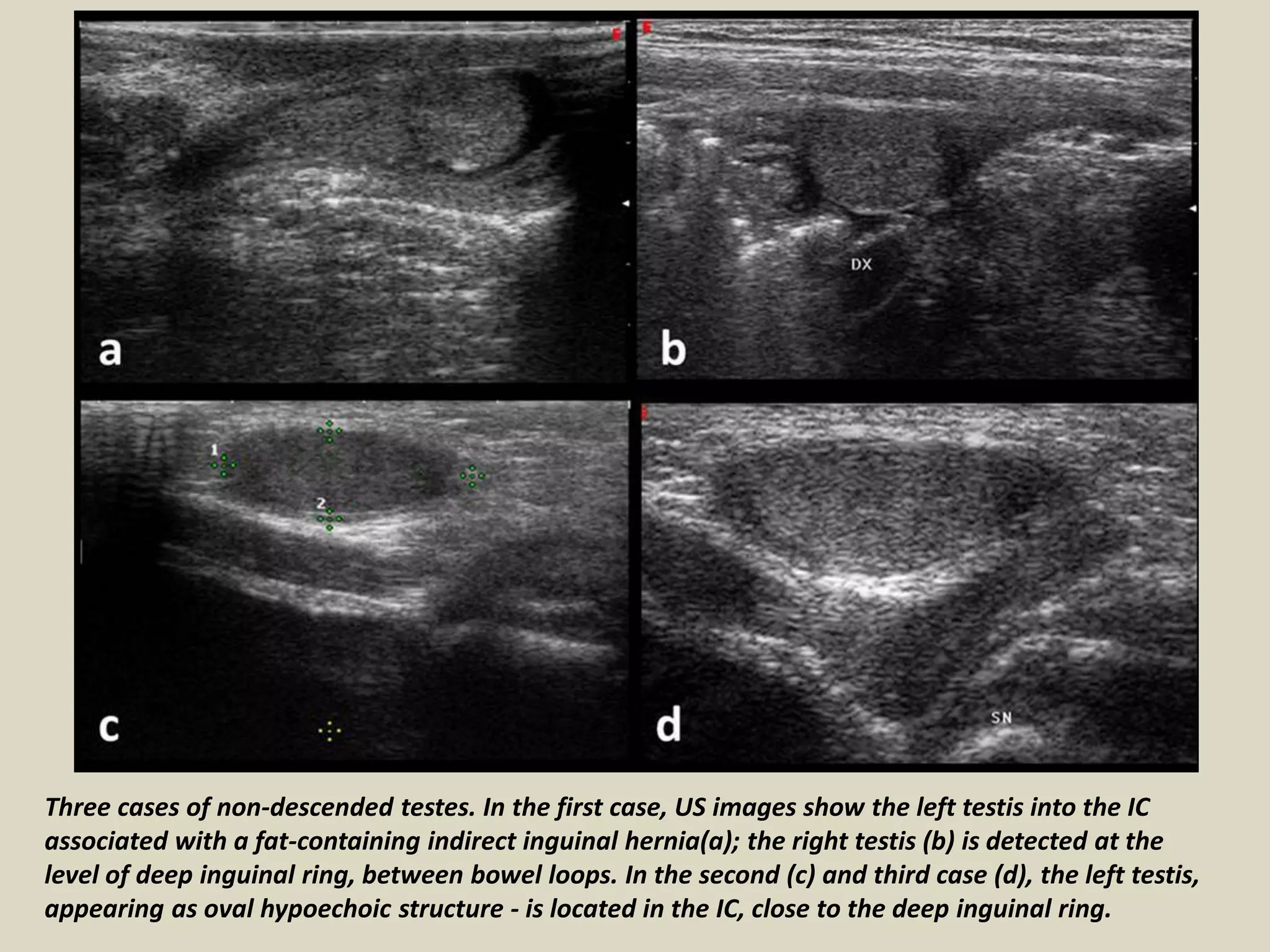 Presentation1, radiological imaging of undescended testis. | PPTX