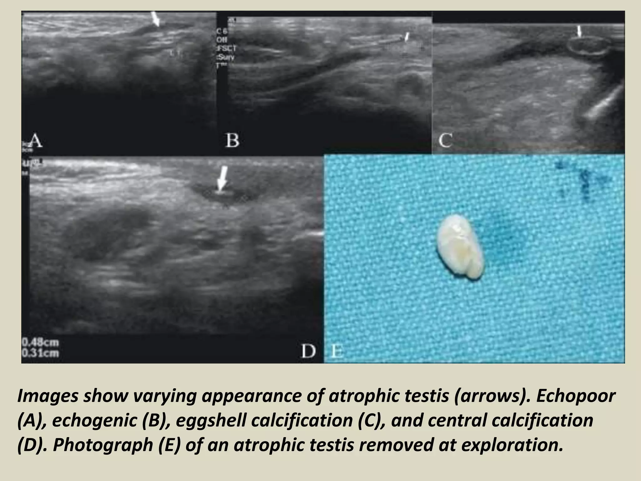 Presentation1, radiological imaging of undescended testis. | PPTX