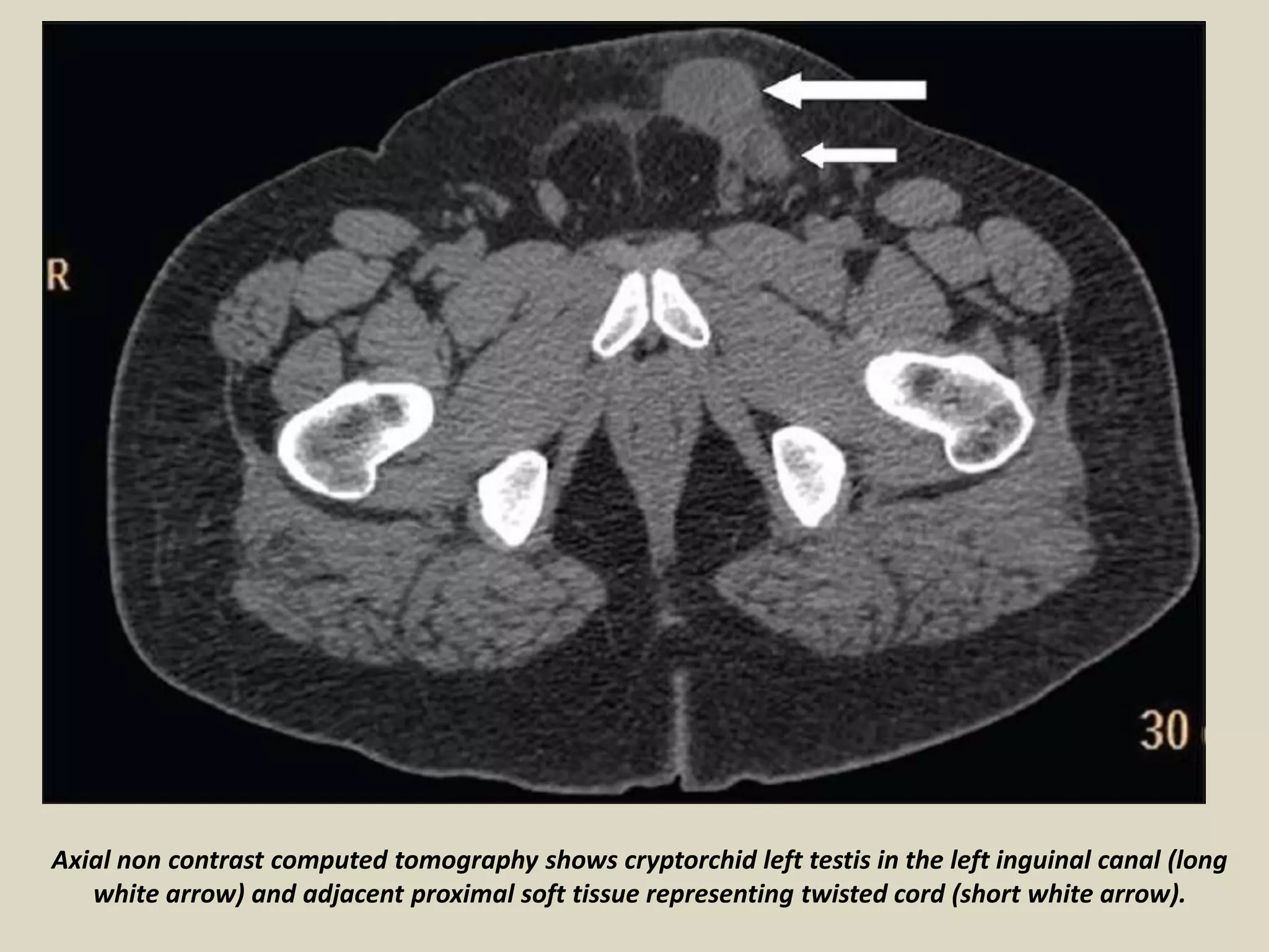 Presentation1, radiological imaging of undescended testis. | PPTX